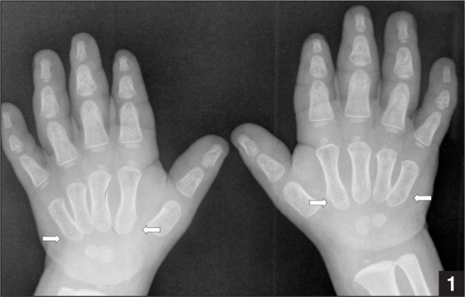 Acromicric Dysplasia - MyBioSource Learning Center