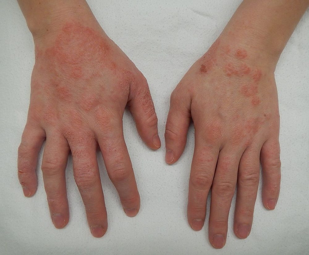 Dermatitis | MyBioSource Learning Center