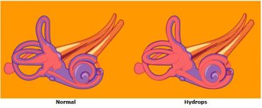Endolymphatic Hydrops | MyBioSource Learning Center