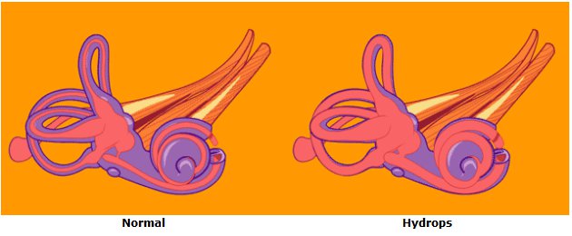 Endolymphatic Hydrops | MyBioSource Learning Center