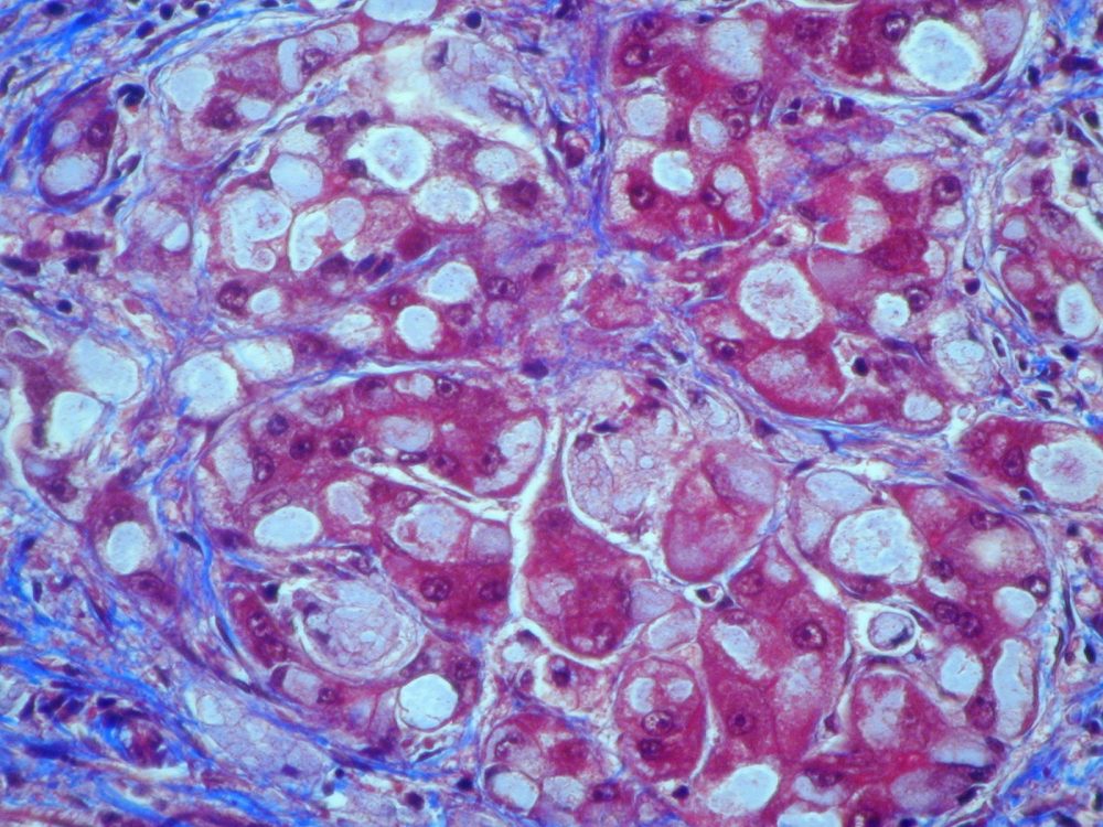 Glycogen Storage Disease Type I (GSDI) | MyBioSource Learning Center