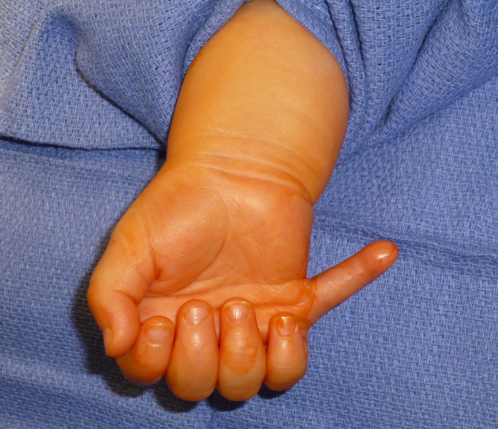Hand-Deformities - MyBioSource Learning Center