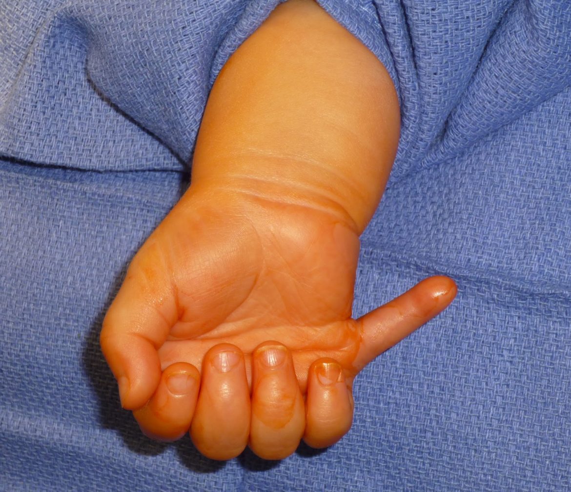 Hand-Deformities - MyBioSource Learning Center