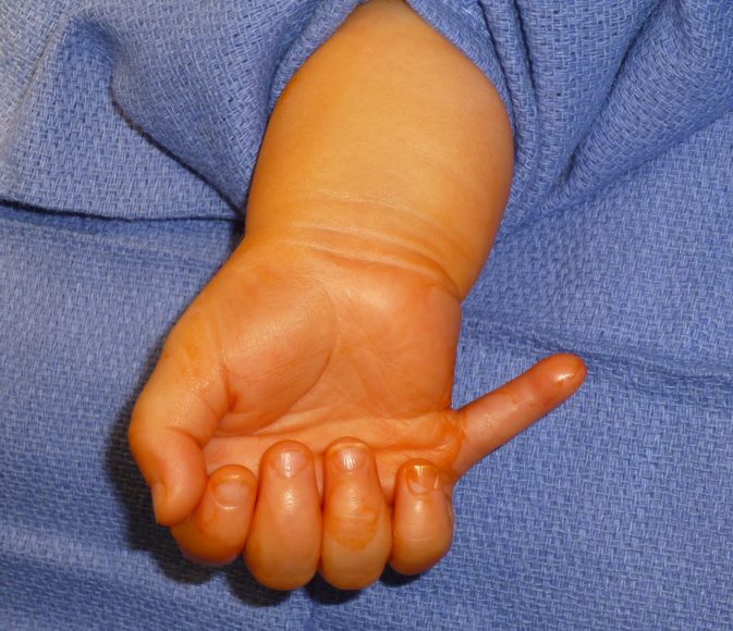 Hand-Deformities - MyBioSource Learning Center