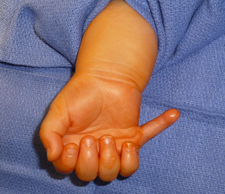 Hand-Deformities - MyBioSource Learning Center