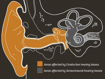 Sensorineural Hearing Loss | MyBioSource Learning Center