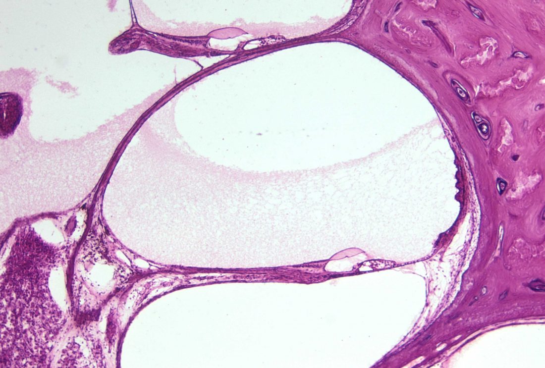 Endolymphatic Hydrops | MyBioSource Learning Center