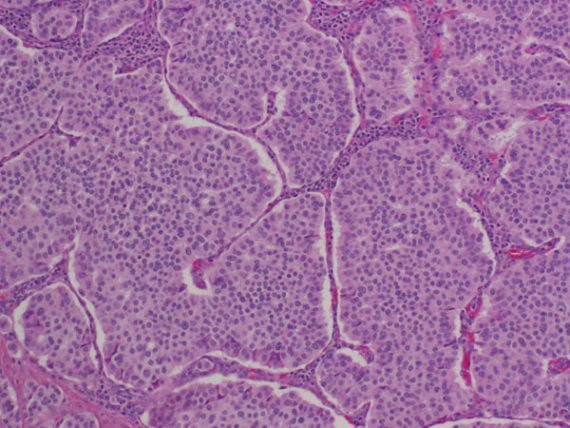 Endocrine Gland Neoplasms | MyBioSource Learning Center