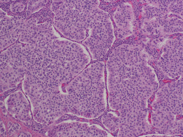 Endocrine Gland Neoplasms - MyBioSource Learning Center